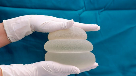 5 dúvidas sobre o explante de silicone - D'IDÉES MAGAZINE